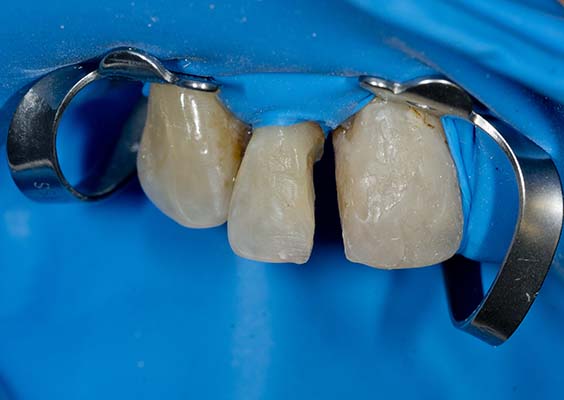 Clinical Case Fusion™ Anterior Matrix System - Forum Stomatologii ...